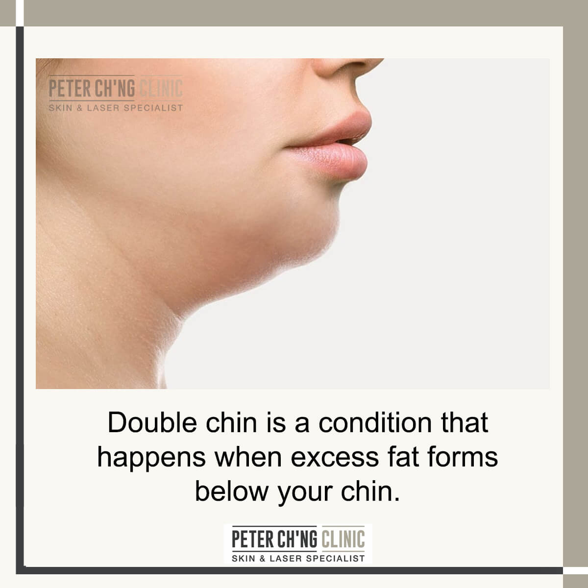 3 Best Non-Surgical Procedures to Get rid of a Double Chin | Peter Ch ...