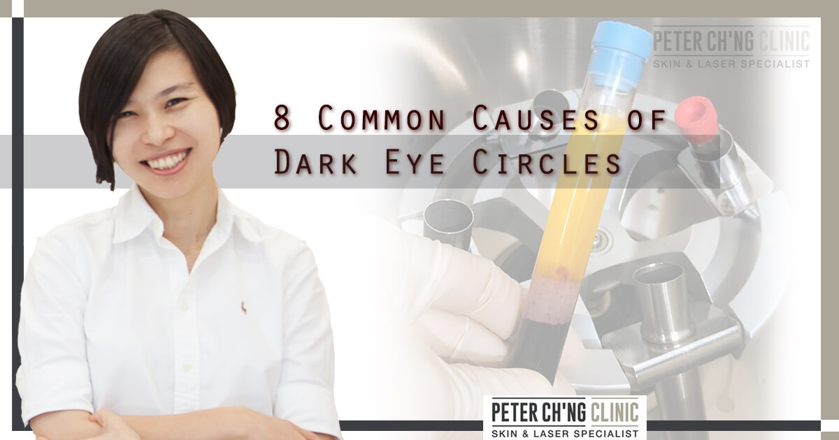 Common Causes of Dark Eye Circles | Peter Ch'ng Skin Specialist - KL ...