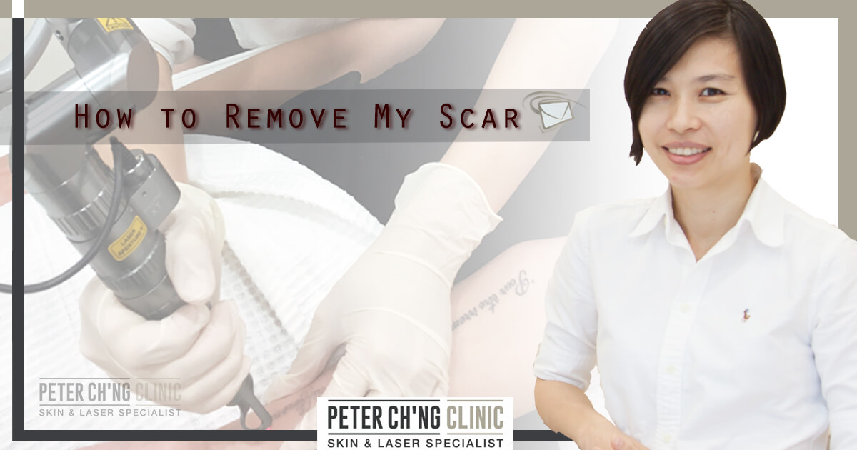 5 Types of Scars You Have That Can Actually Be Removed | Peter Ch'ng ...