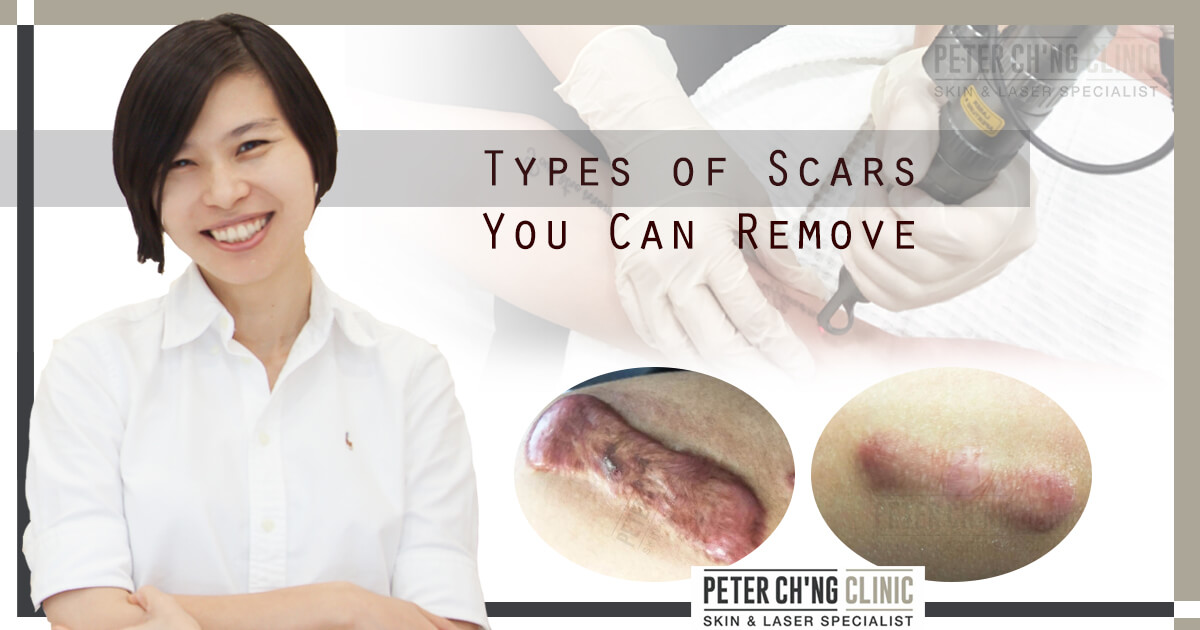 5 Types of Scars You Have That Can Actually Be Removed | Peter Ch'ng ...
